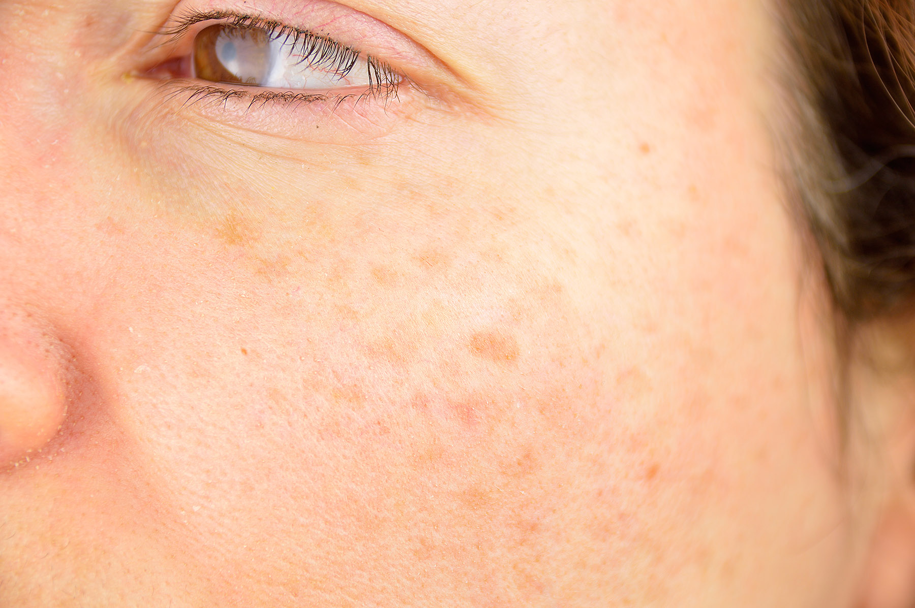 Age Spots Treatment Twickenham - Pigmentation Treatment