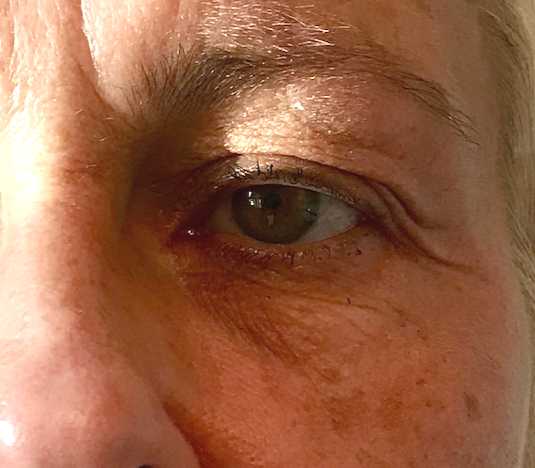 Treatment For Heavy Eye Lids Twickenham | Thames Skin Clinic