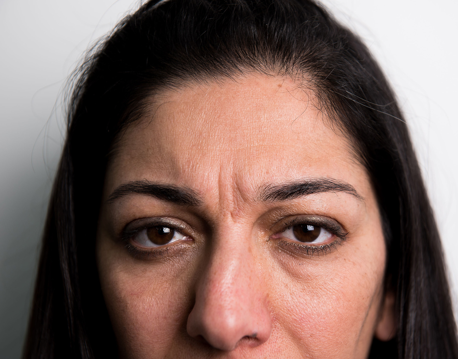 Frown Lines Treatment Twickenham | Thames Skin Clinic