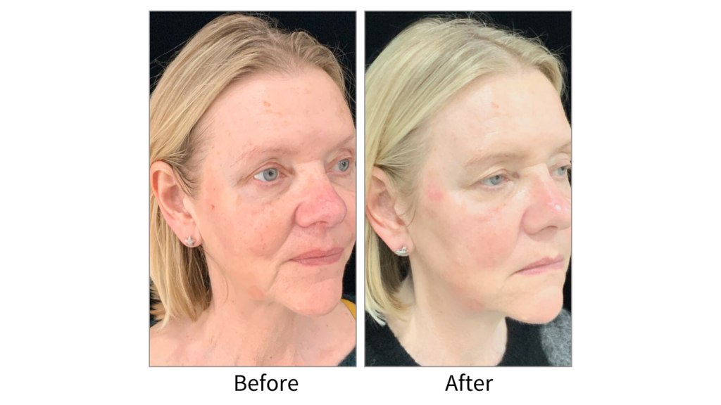 What’s Your Facial Aging Type? - Thames Skin Clinic