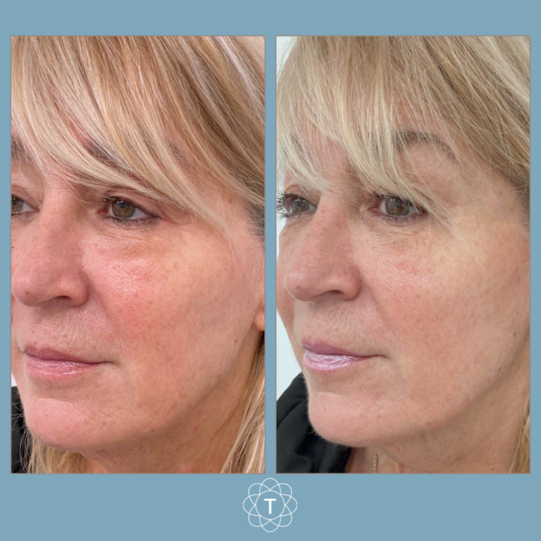 Profhilo Structura - Thames Skin Clinic